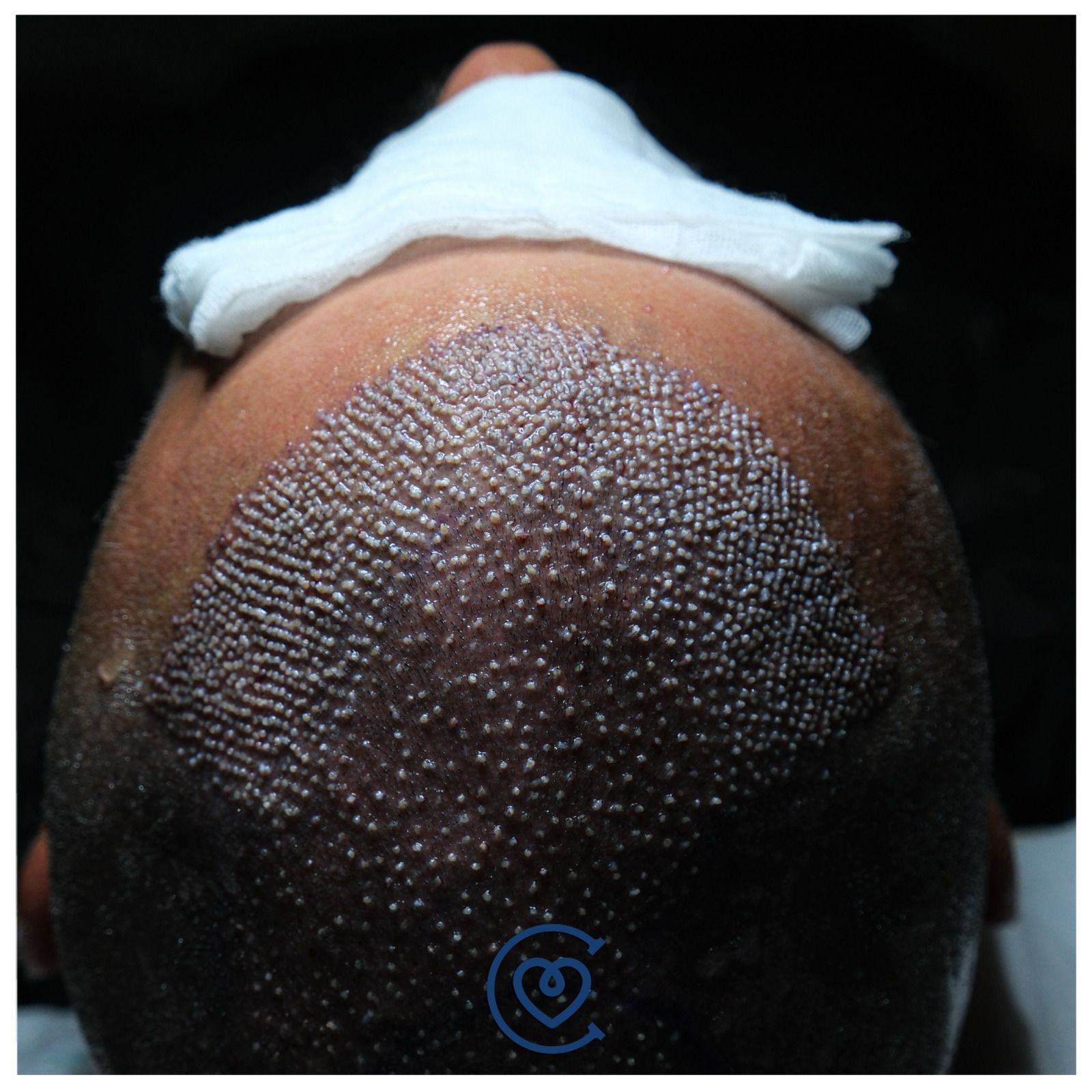 Greffe de cheveux Sapphire FUE | Précision et innovation